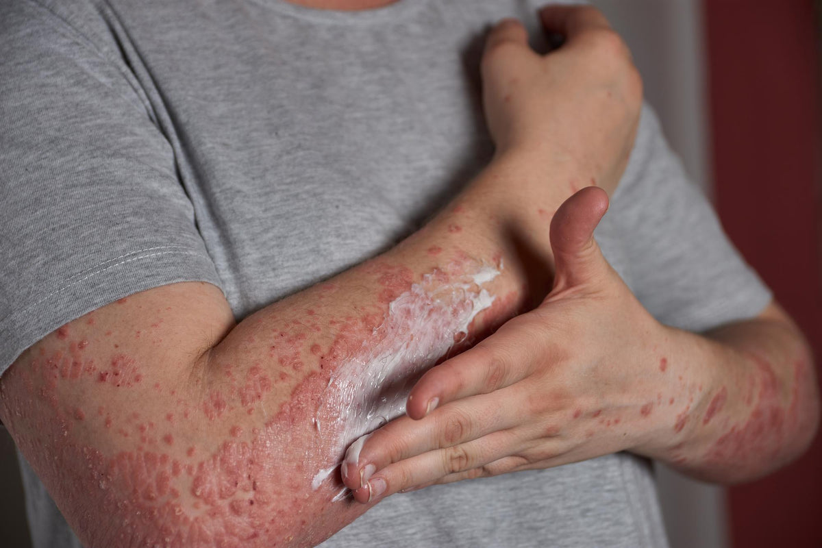 Understanding Eczema Herpeticum Contagiousness How Long Should You Be PurClarity Skincare